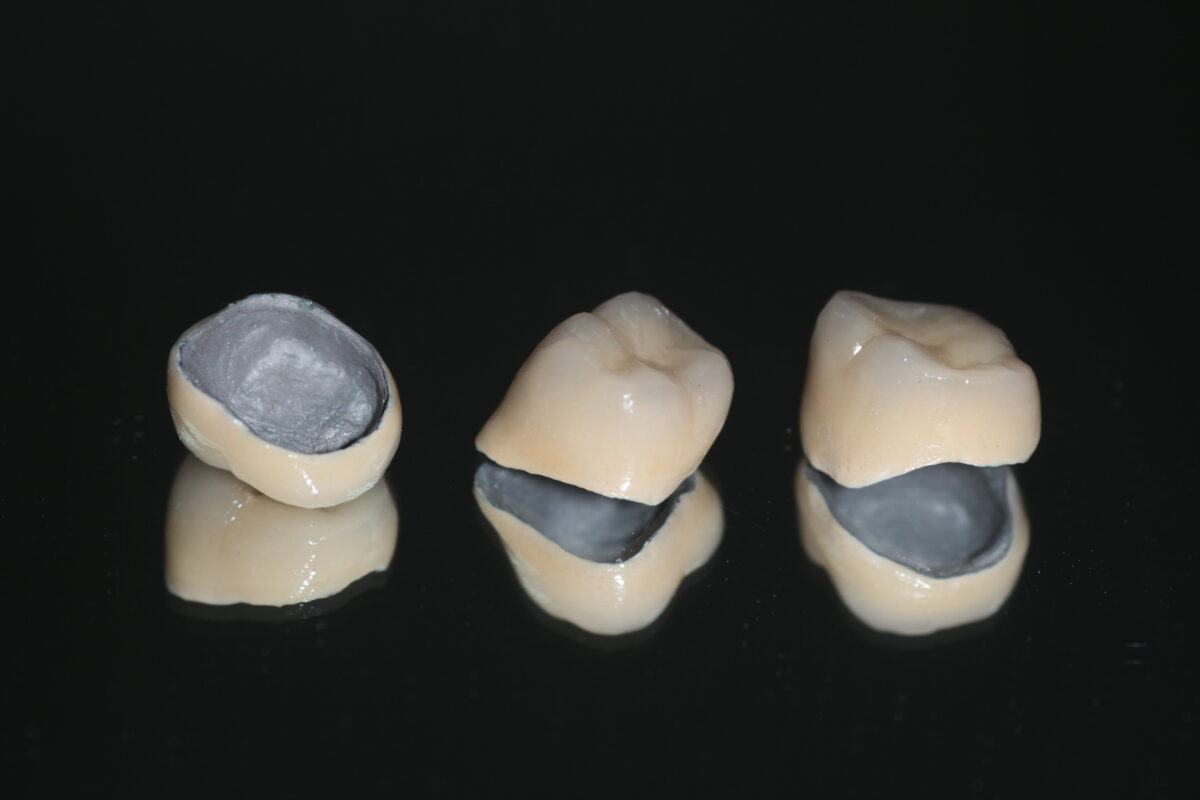 Placing A Custom Dental Crown | Fort Bliss, TX